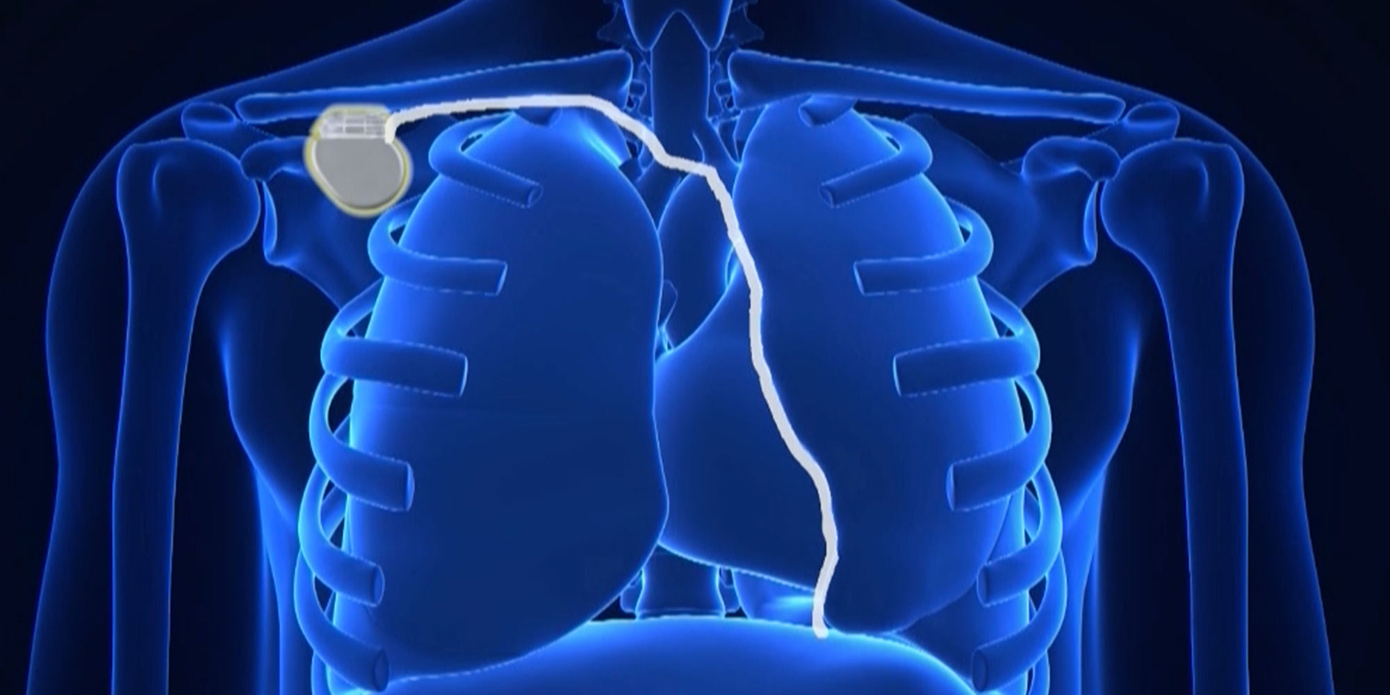 First to Treat Central Sleep Apnea with New Device - Cooper and Inspira ...